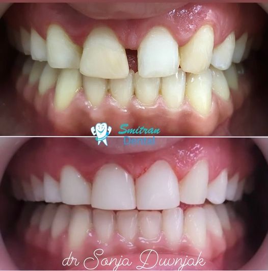 Kompozitne fasete | Smitran dental