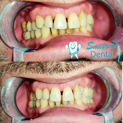 Parodontopatija | Smitran dental